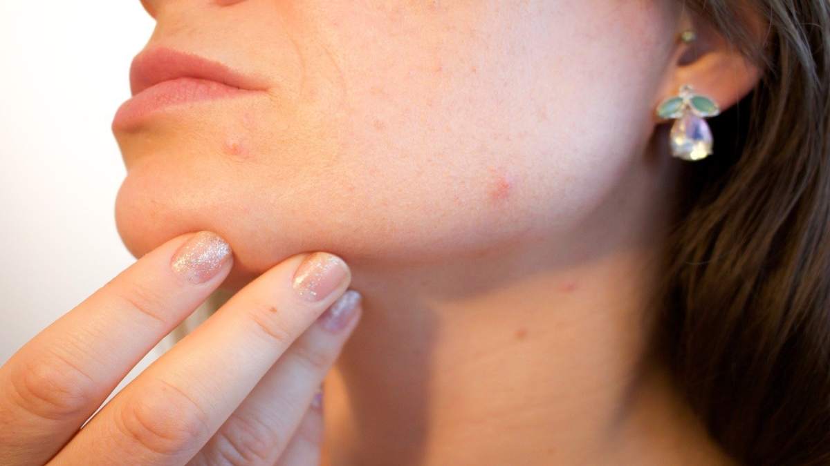 How To Reduce Redness On Face 11 Possible Causes And Home Remedies